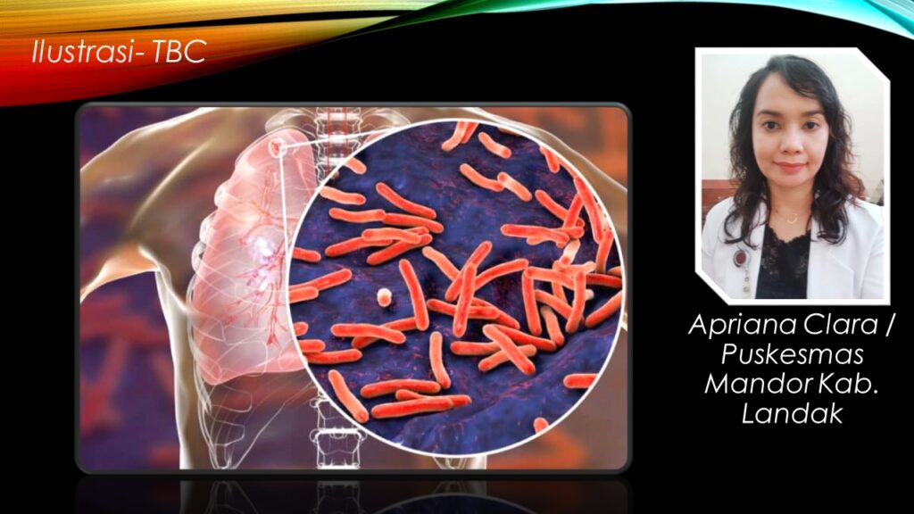 Waspada terhadap Penularan Penyakit Tuberkulosis (TBC) | Majalah DUTA